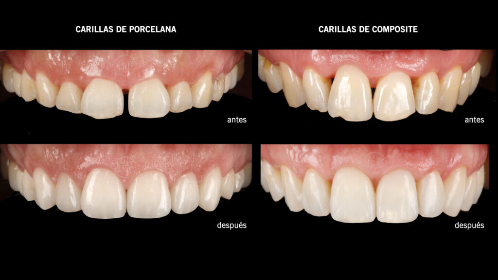 La solución para una sonrisa perfecta y natural: descubre las claves ...